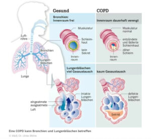 Pflege bei COPD | Pflegeratgeber - Korian