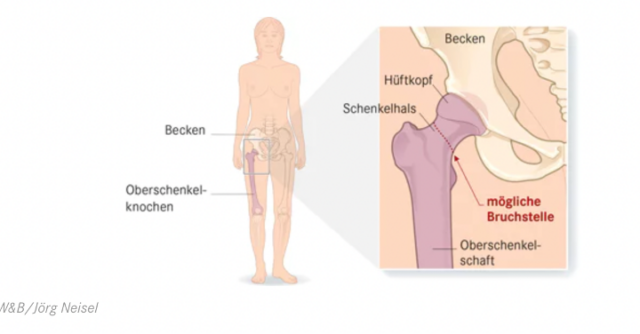 Pflege bei Oberschenkelhalsbruch | Pflegeratgeber - Korian