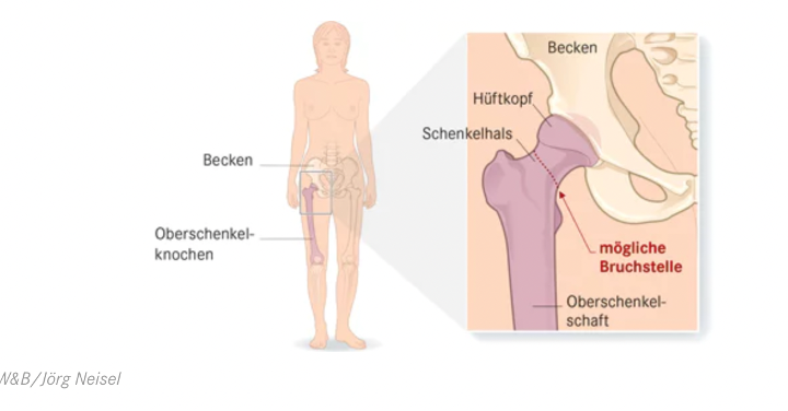Pflege bei Oberschenkelhalsbruch | Pflegeratgeber - Korian
