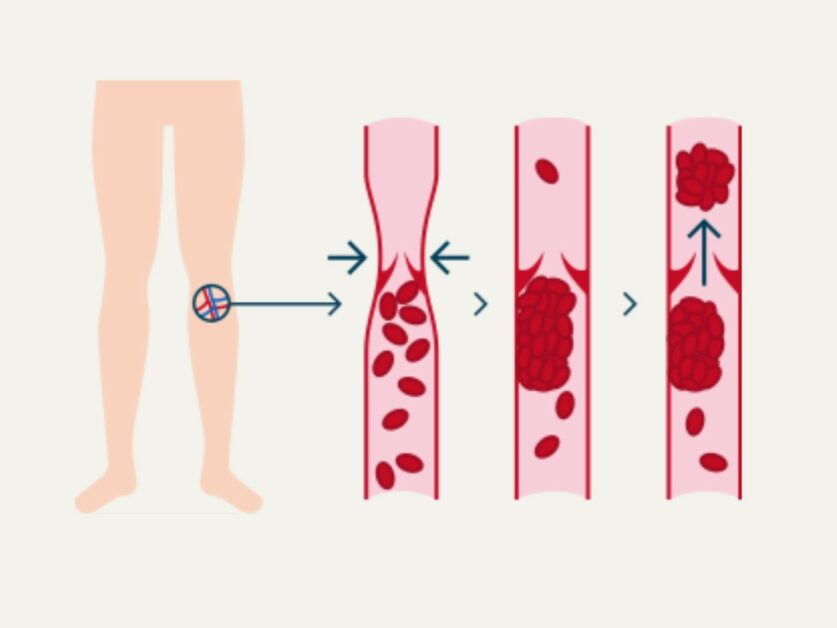 Pflege bei Thrombose | Pflegeratgeber - Korian